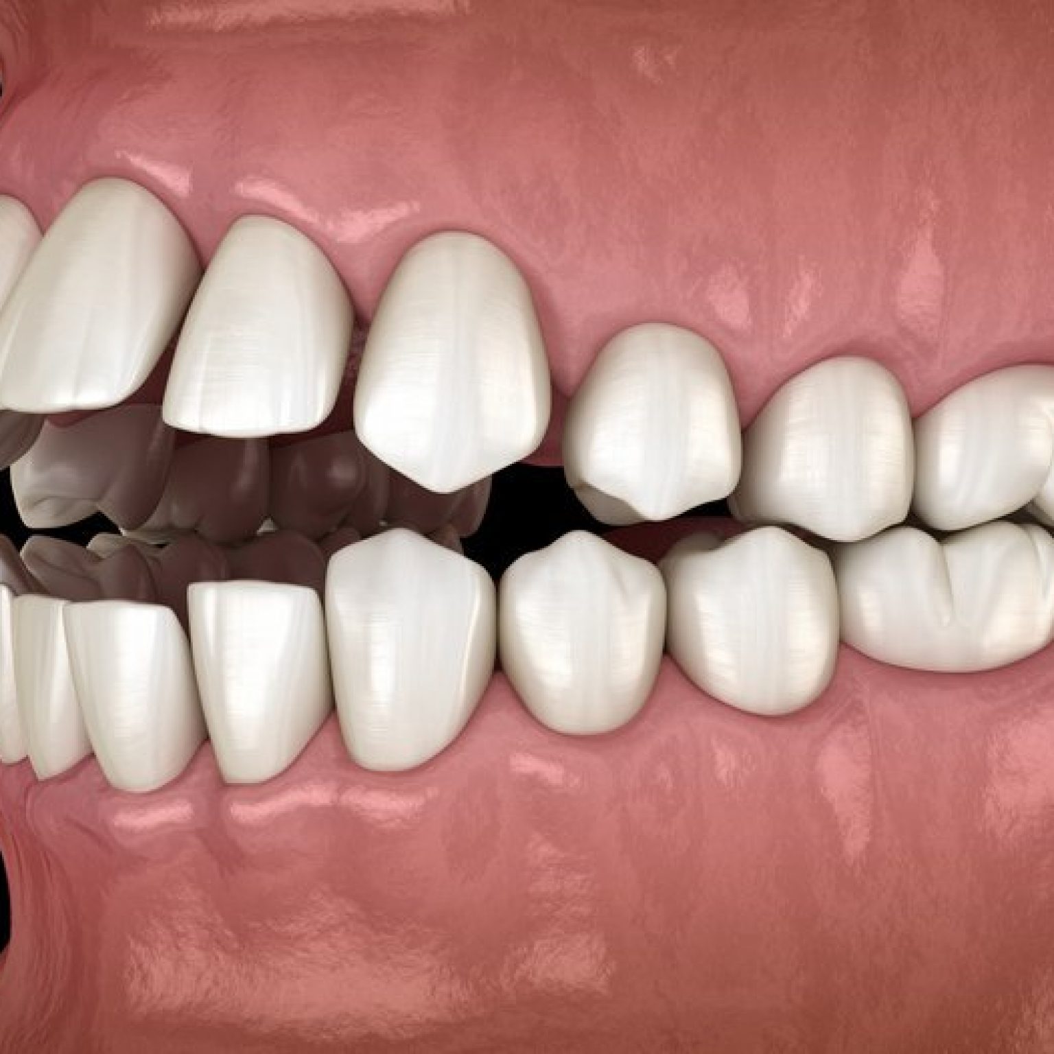 Orthodontic Treatment - Clear and Invisible Braces