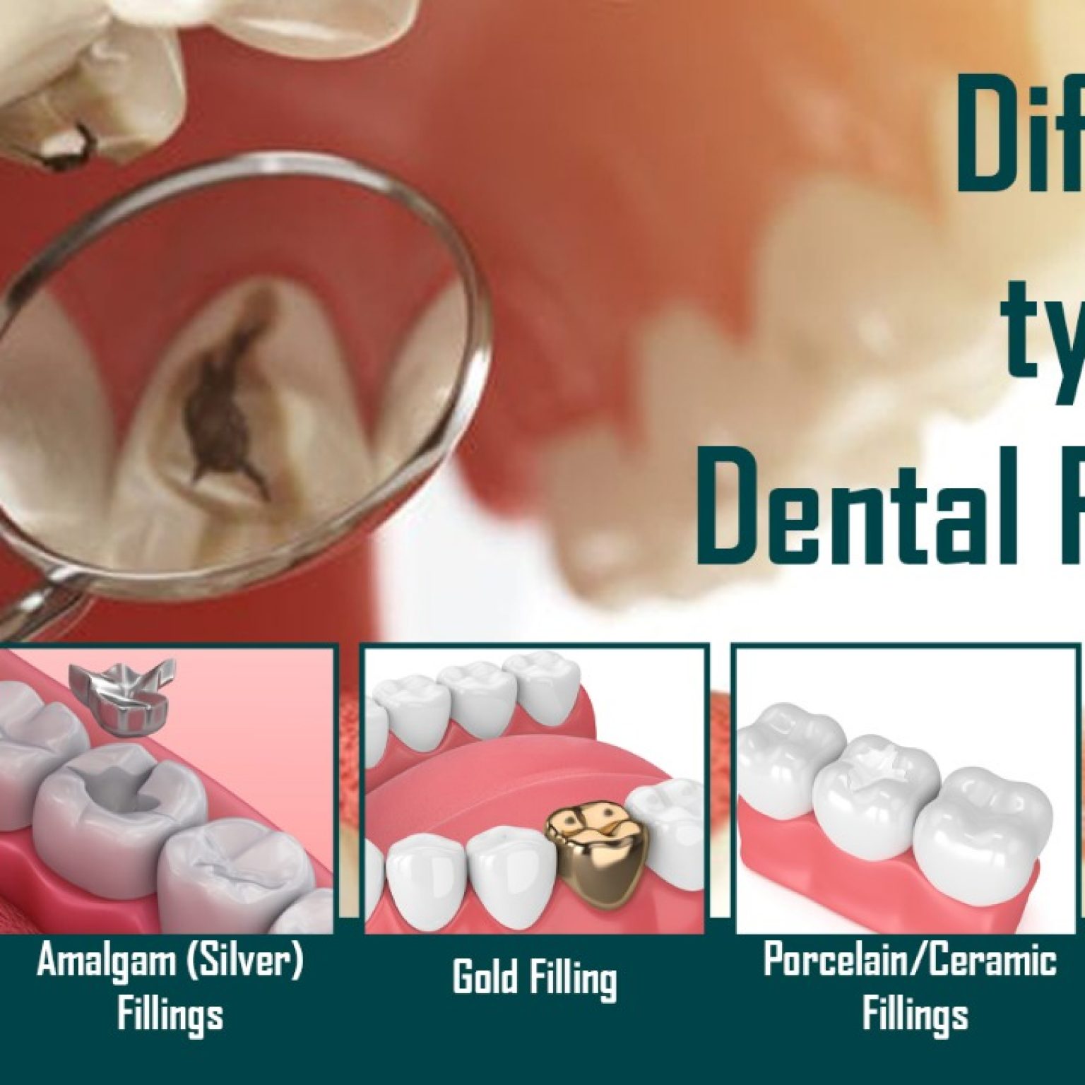 Why Dental Fillings Are Essential for Oral Health