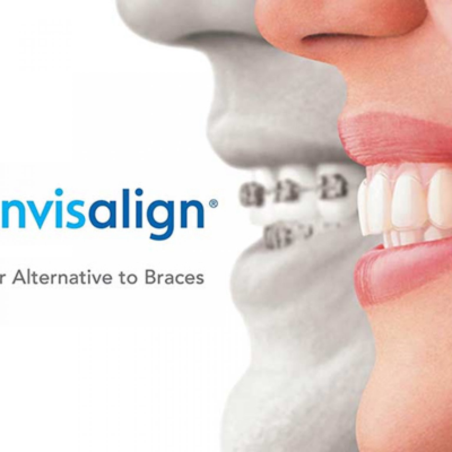 An Introduction To Invisalign In 5 Minutes - My Gentle Dentist
