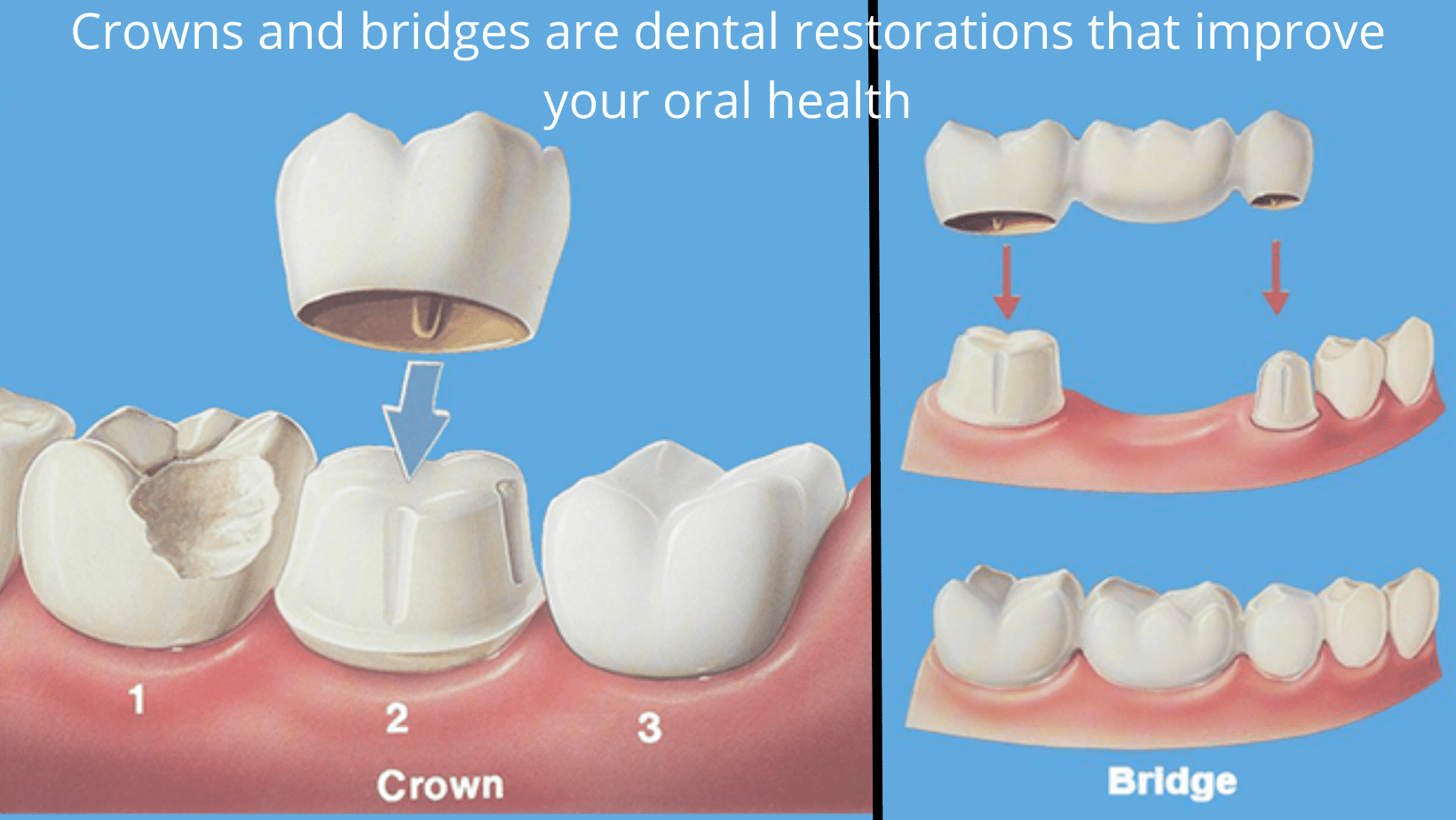 What are Dental Crowns and Bridges?