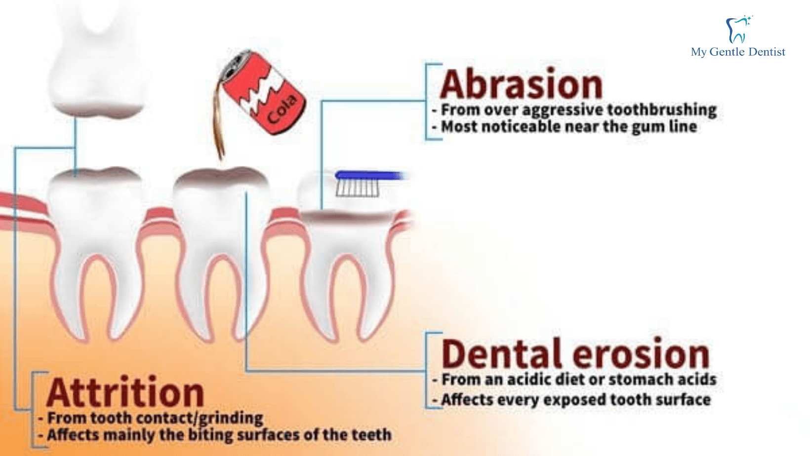 Tooth Wear: Causes, Prevention, and Treatment - My Gentle Dentist Tooth Wear: Causes, Prevention, and Treatment - My Gentle Dentist