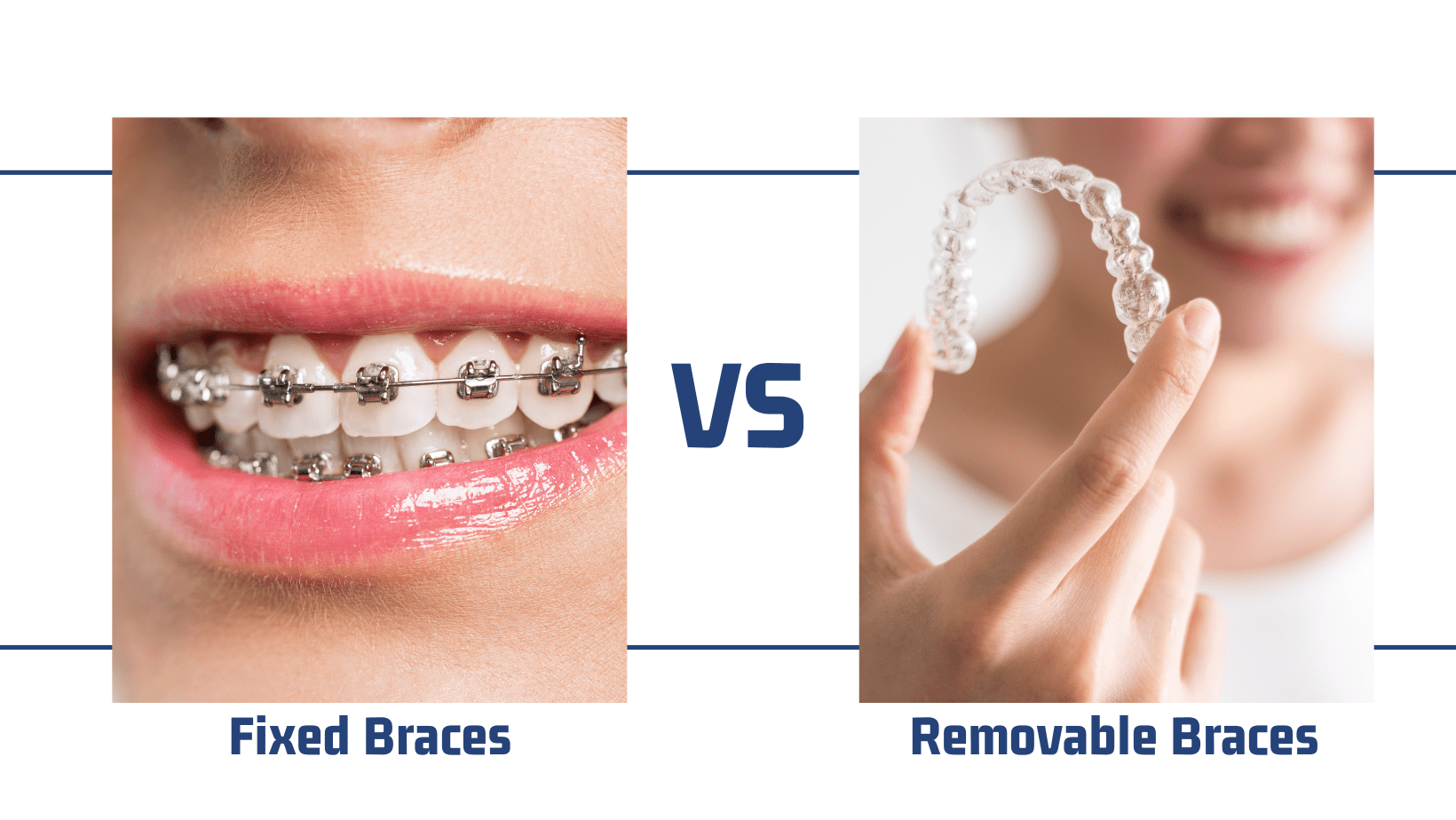Removable Braces Have Their Pros and Cons