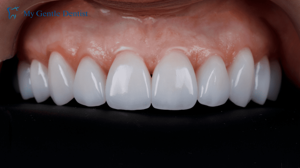 Dental Veneers Explained: Removal, Replacement Options, and Durability