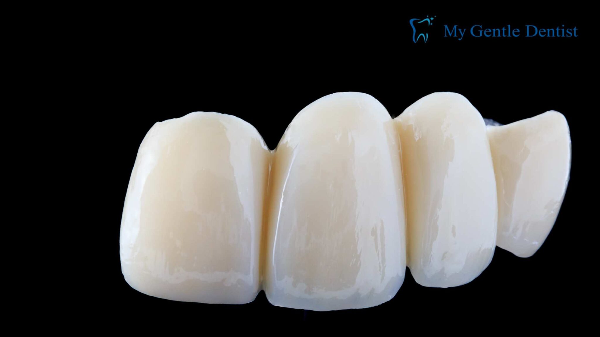 Top 5 Benefits of a Dental Bridge for Missing Teeth