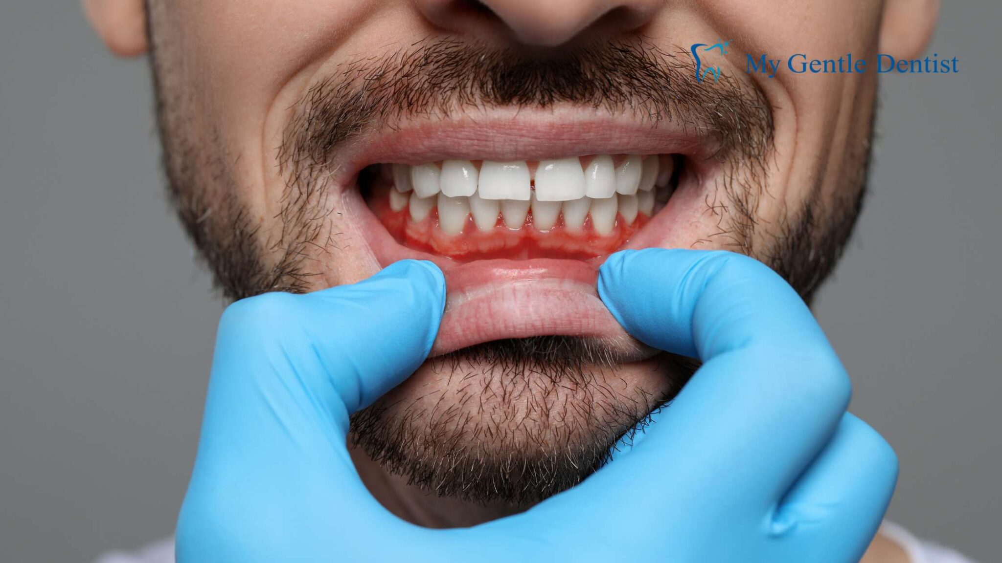 10 Common Symptoms of Gingivitis and How to Address Them