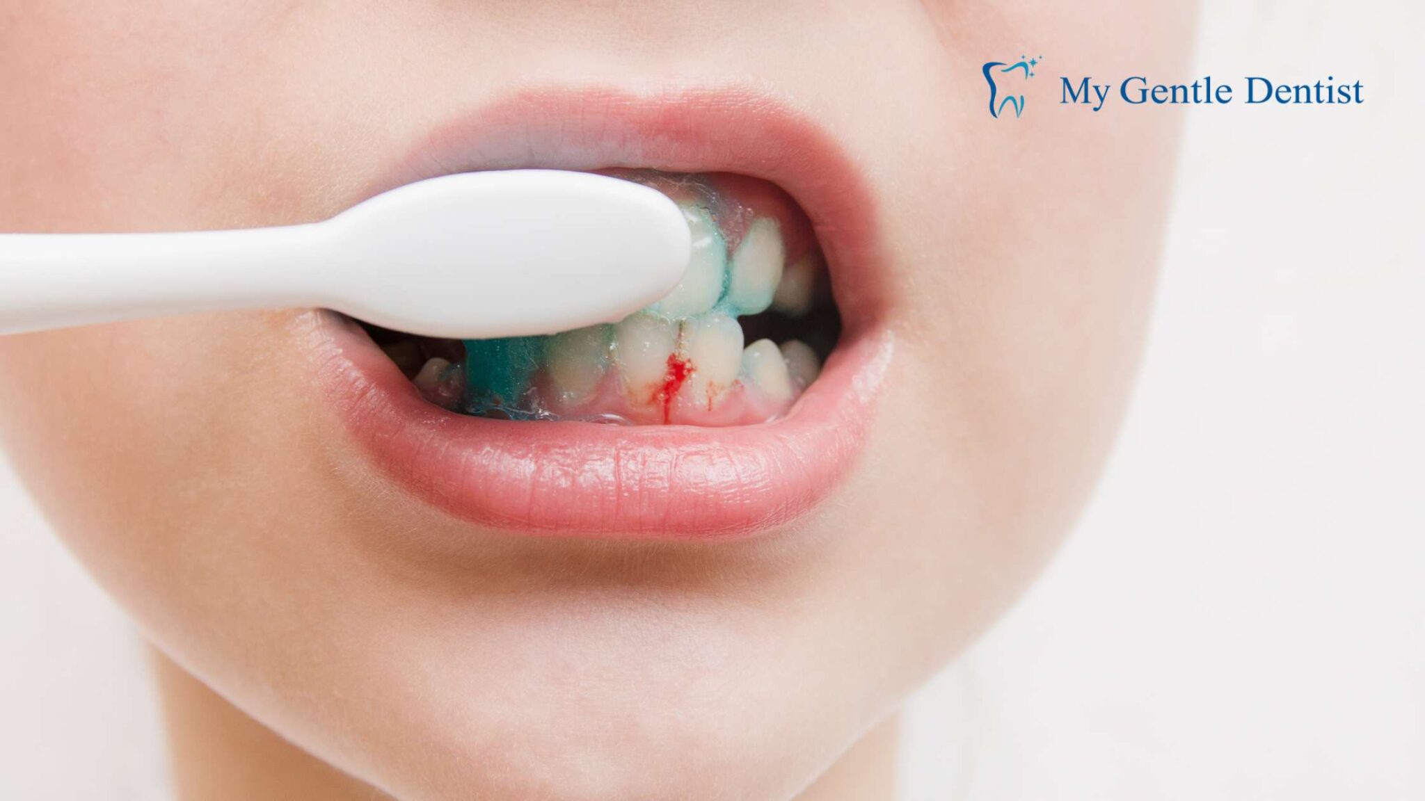 10 Common Symptoms of Gingivitis and How to Address Them